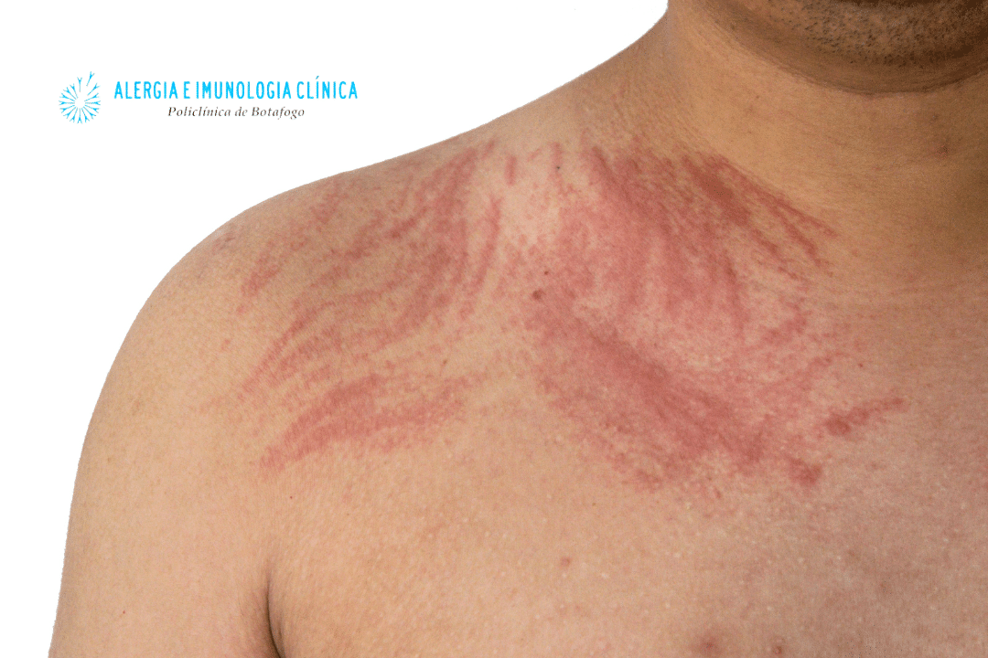 Dermografismo, do diagnóstico ao tratamento. – Alergia Botafogo ...