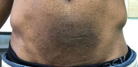 O que é dermatite de contato, causas e como tratar – Alergia Botafogo ...