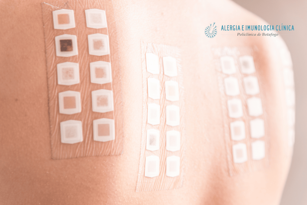 Patch Test O Que Como Feito Alergia Botafogo Alergistas Rio De Janeiro patch-test-o-que-como-feito-alergia-botafogo-alergistas-rio-de-janeiro
